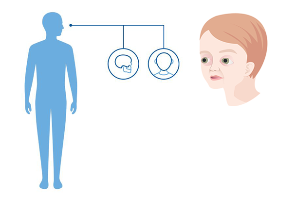 Crouzon syndrom - Oslo universitetssykehus HF