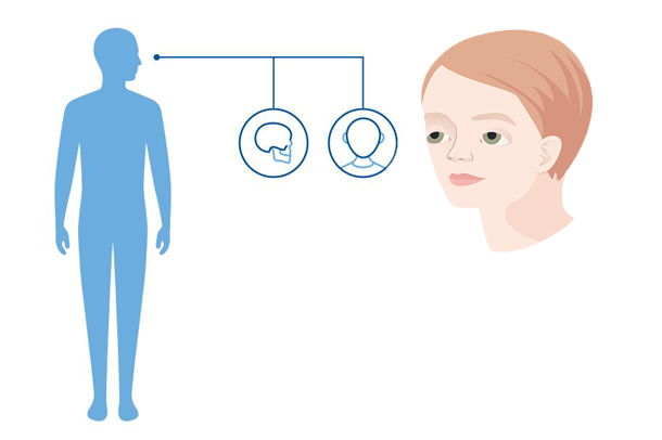 Muenke syndrom - Oslo universitetssykehus HF