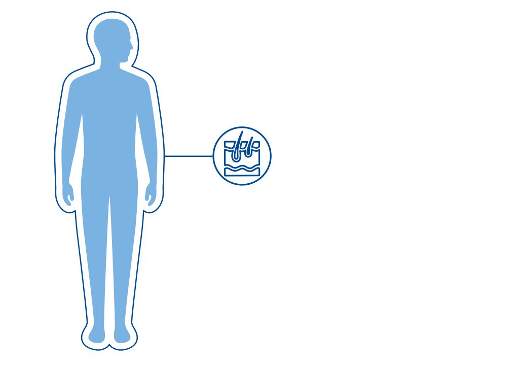 Epidermolysis bullosa (EB) - mild/moderat form - Oslo ...