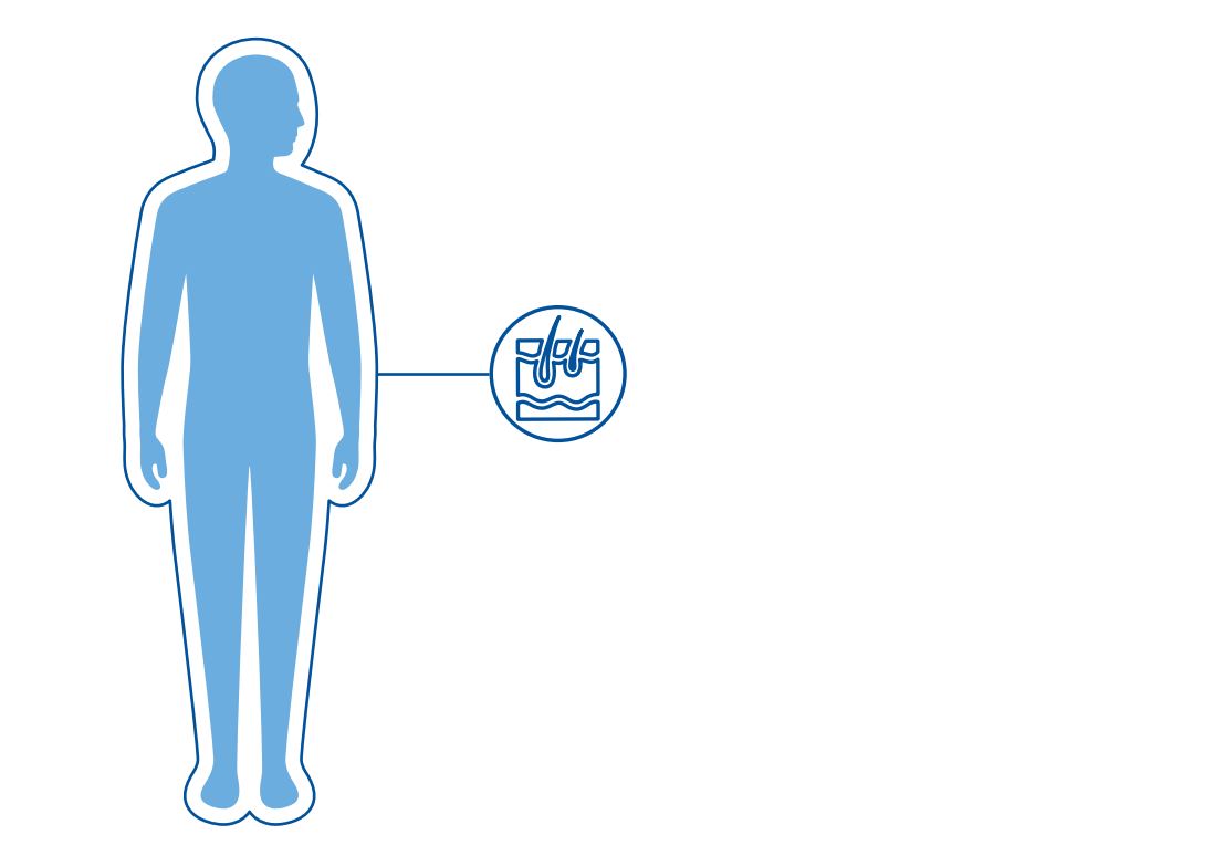 Netherton syndrom - Oslo universitetssykehus HF