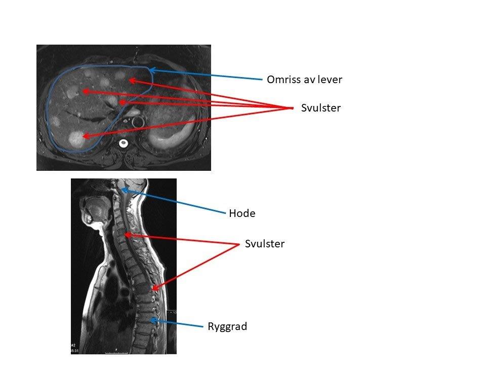 Utredning ved nevroendokrine svulster - Oslo universitetssykehus HF